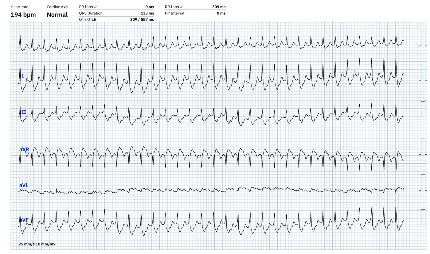 AVNRT TYPICAL FORM | ECG Guru - Instructor Resources